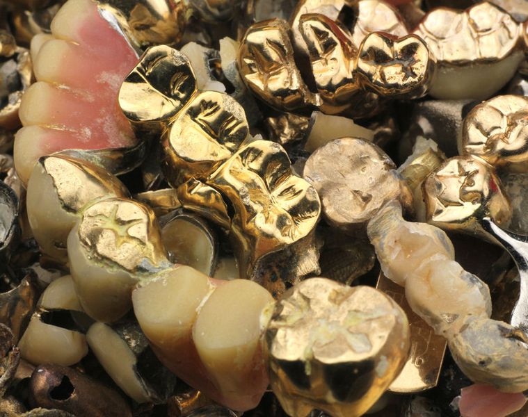 Zahngold Ankauf, Zahngold verkaufen, Goldkronen Ankauf | ESG Gold-Ankauf.de